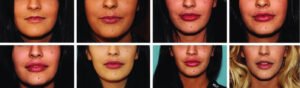 Fases Do Preenchimento Labial